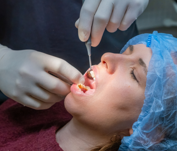 Curodont Los Angeles | Natural Non-Invasive Cavity Treatment & Healing